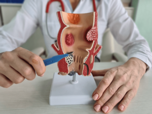 Piles Or Haemorrhoids (Bawaseer) - Medicsi